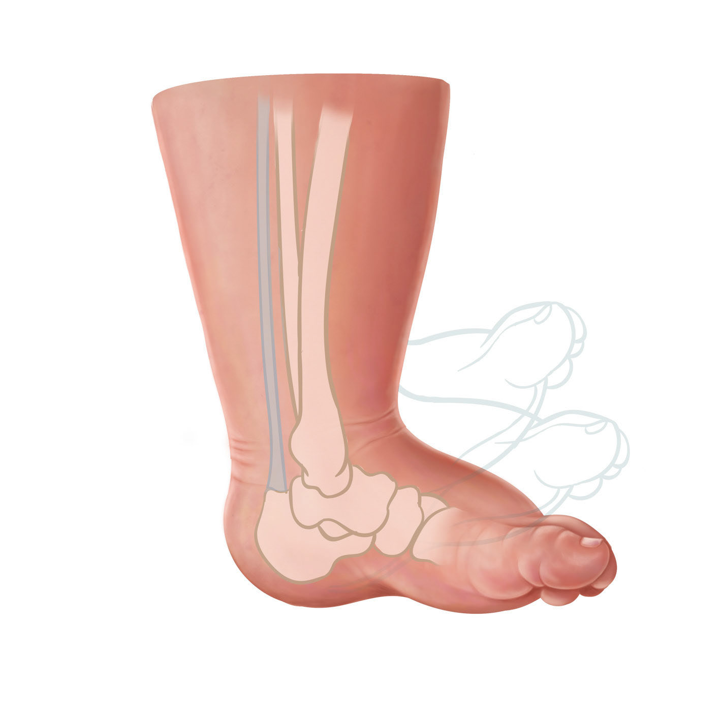 Emma Scheltema Illustration - Clubfoot Tenotomy for Starship Child Health