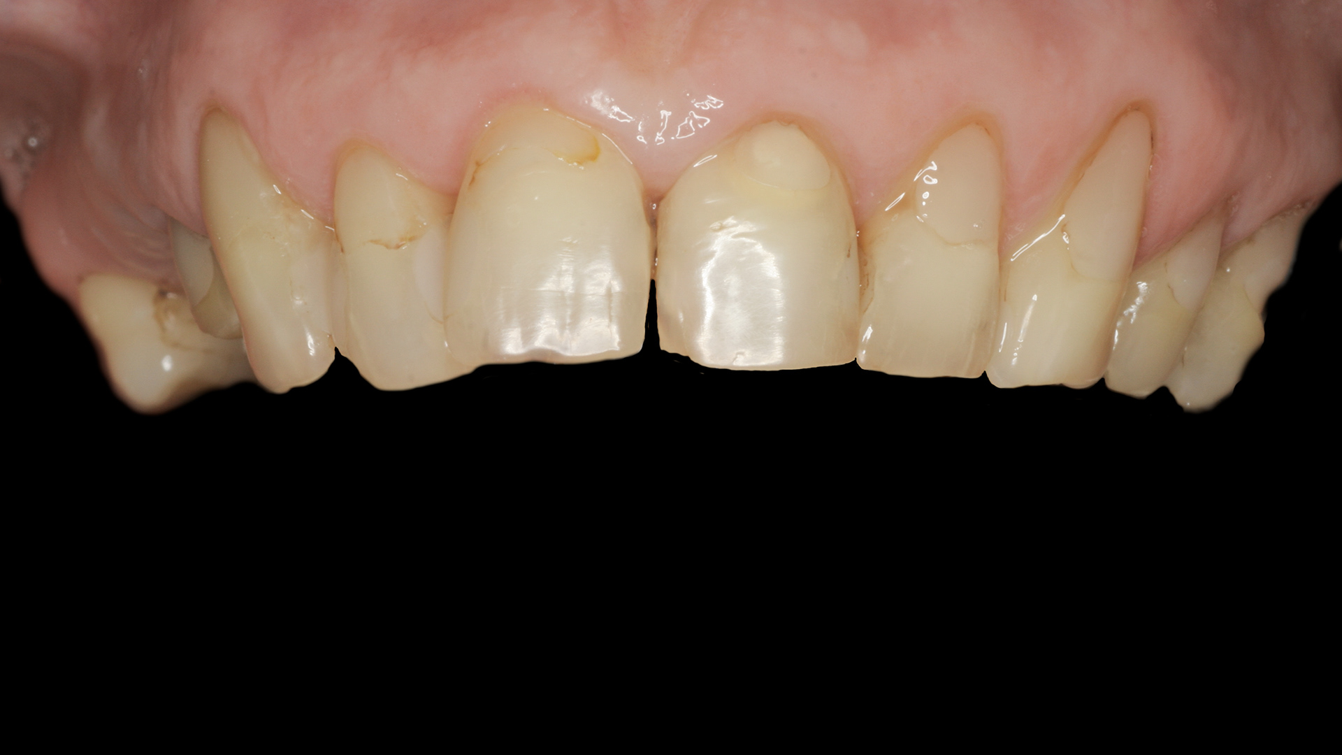 Miazga – Stomatologia Mikroskopowa - • mosty pełnoceramiczne